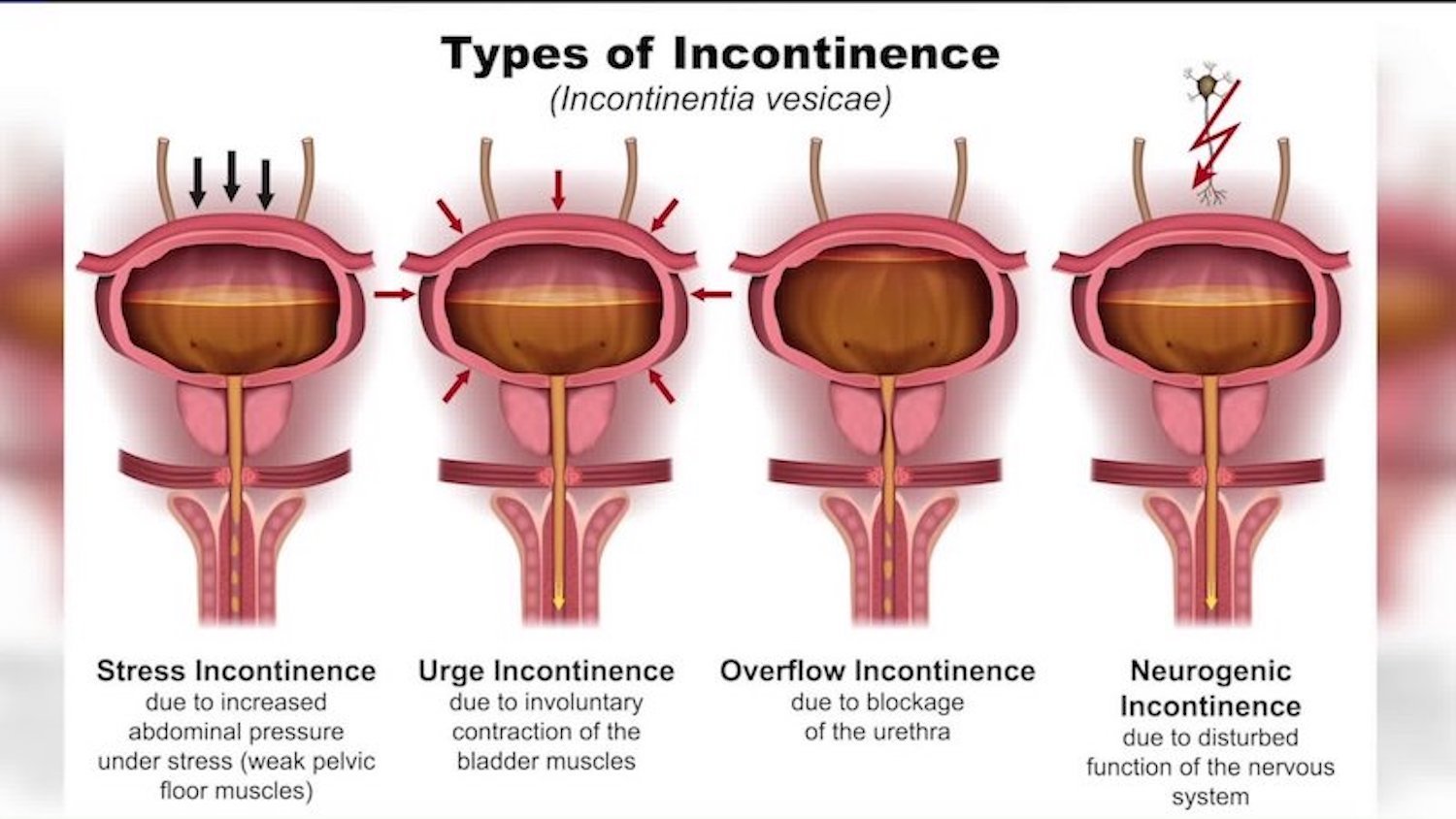 Incontinence Options to help with Bladder Control - Baby Bod Program